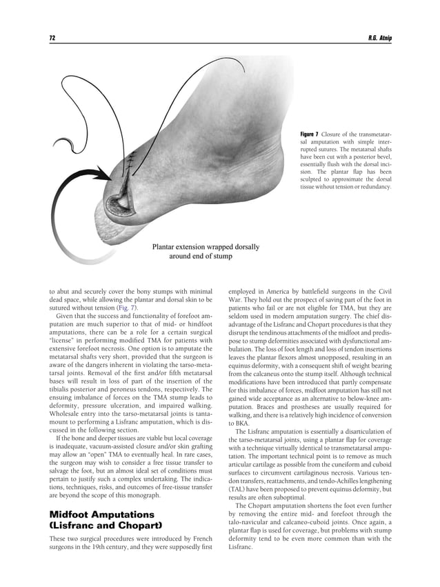 Toe and Partial Foot Amputations | PDF | Death, Injury, or Military ...