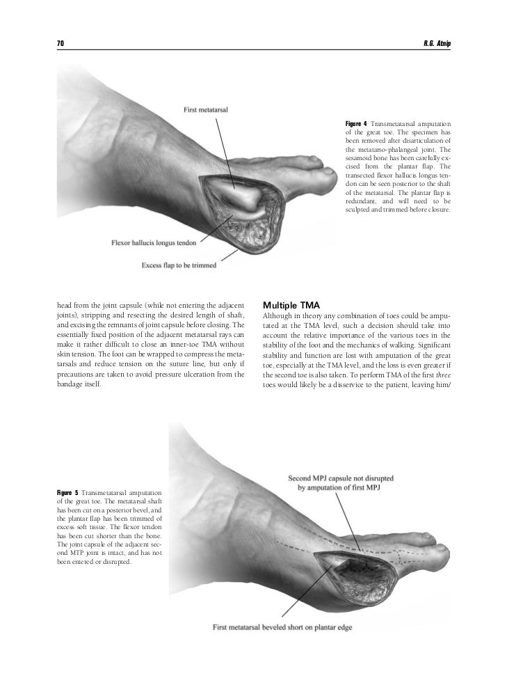 Toe and Partial Foot Amputations