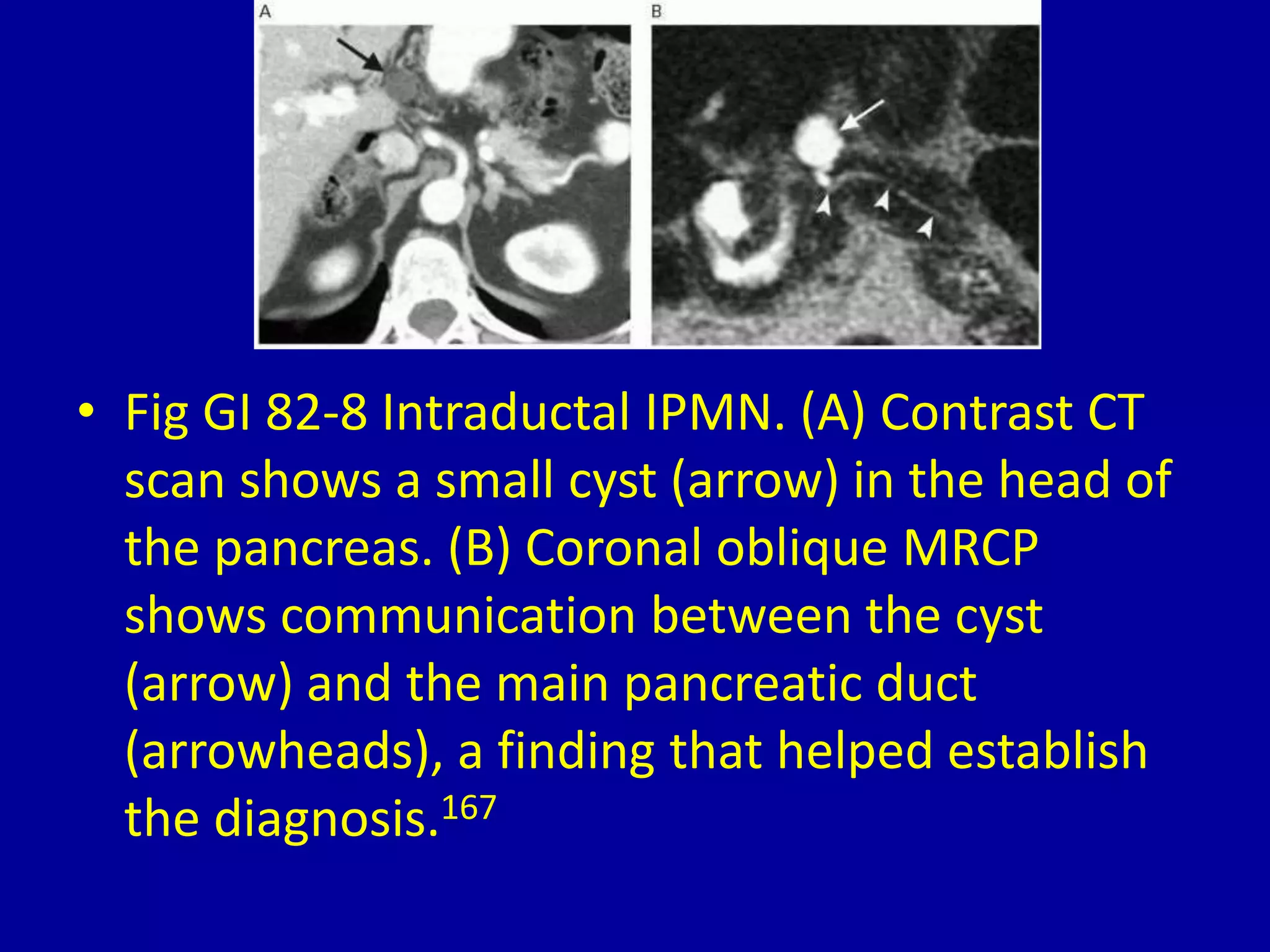 82 cystic pancreatic masses on ct and mri | PPTX
