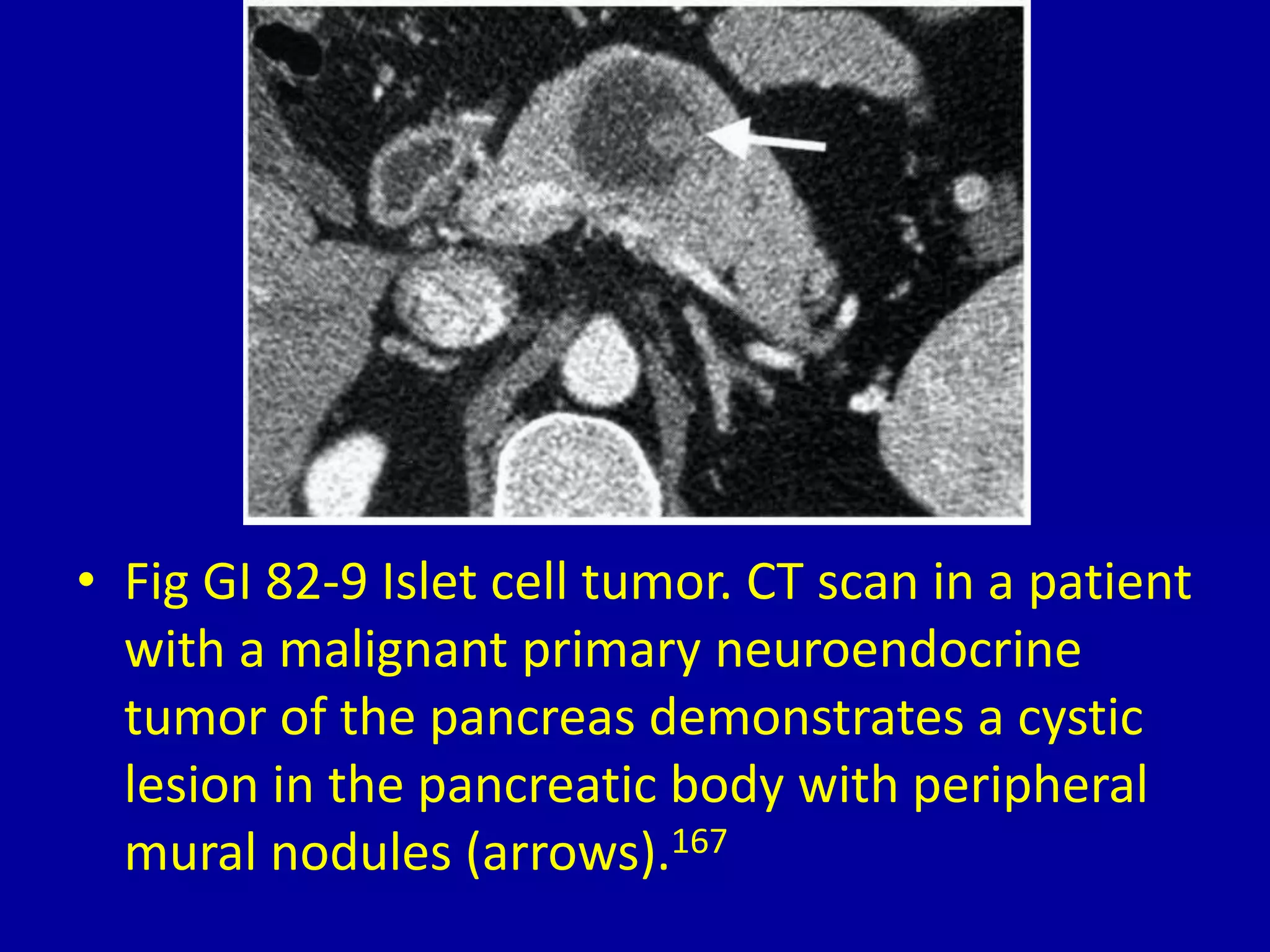 82 cystic pancreatic masses on ct and mri | PPTX