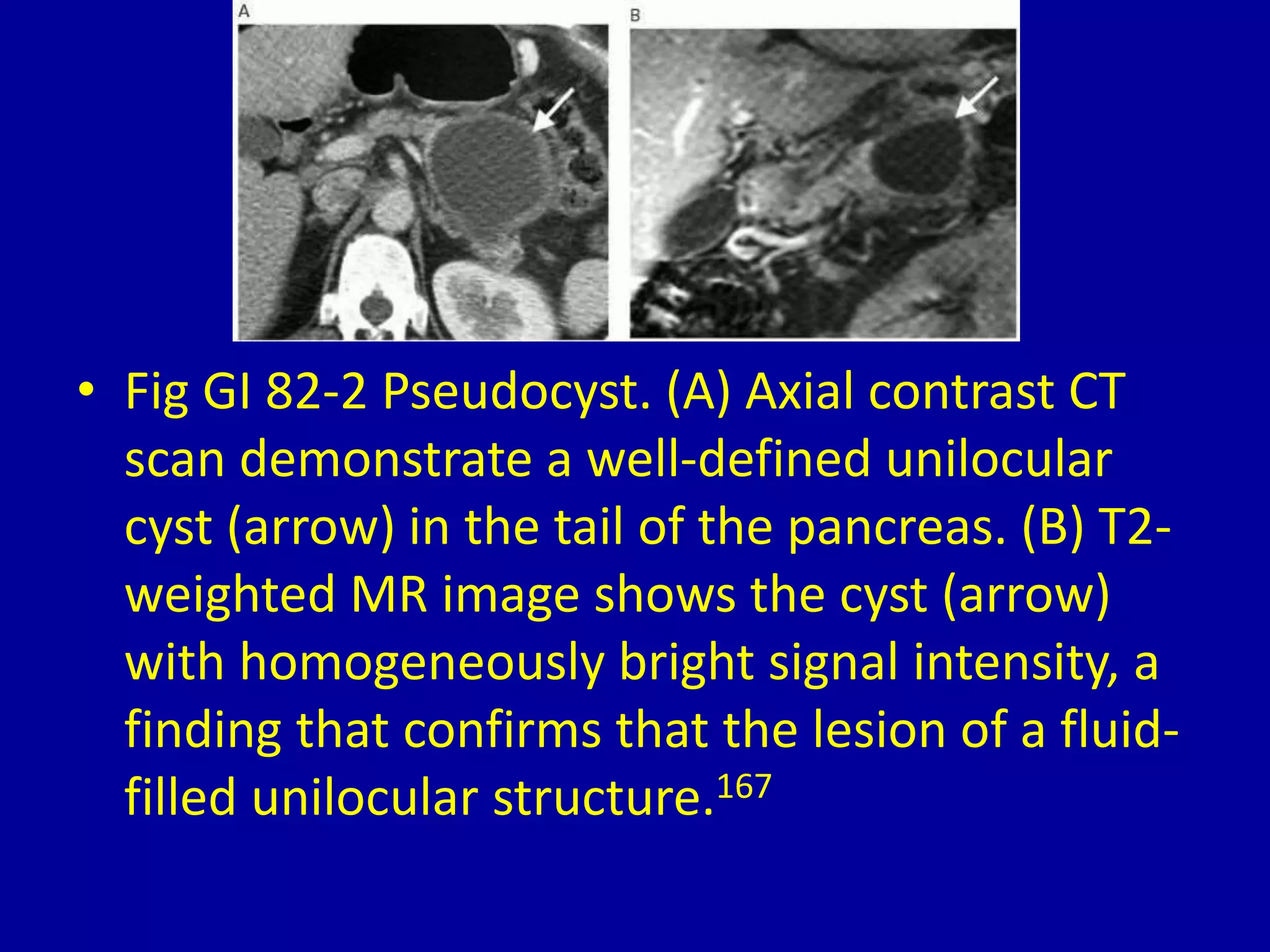 82 cystic pancreatic masses on ct and mri | PPTX