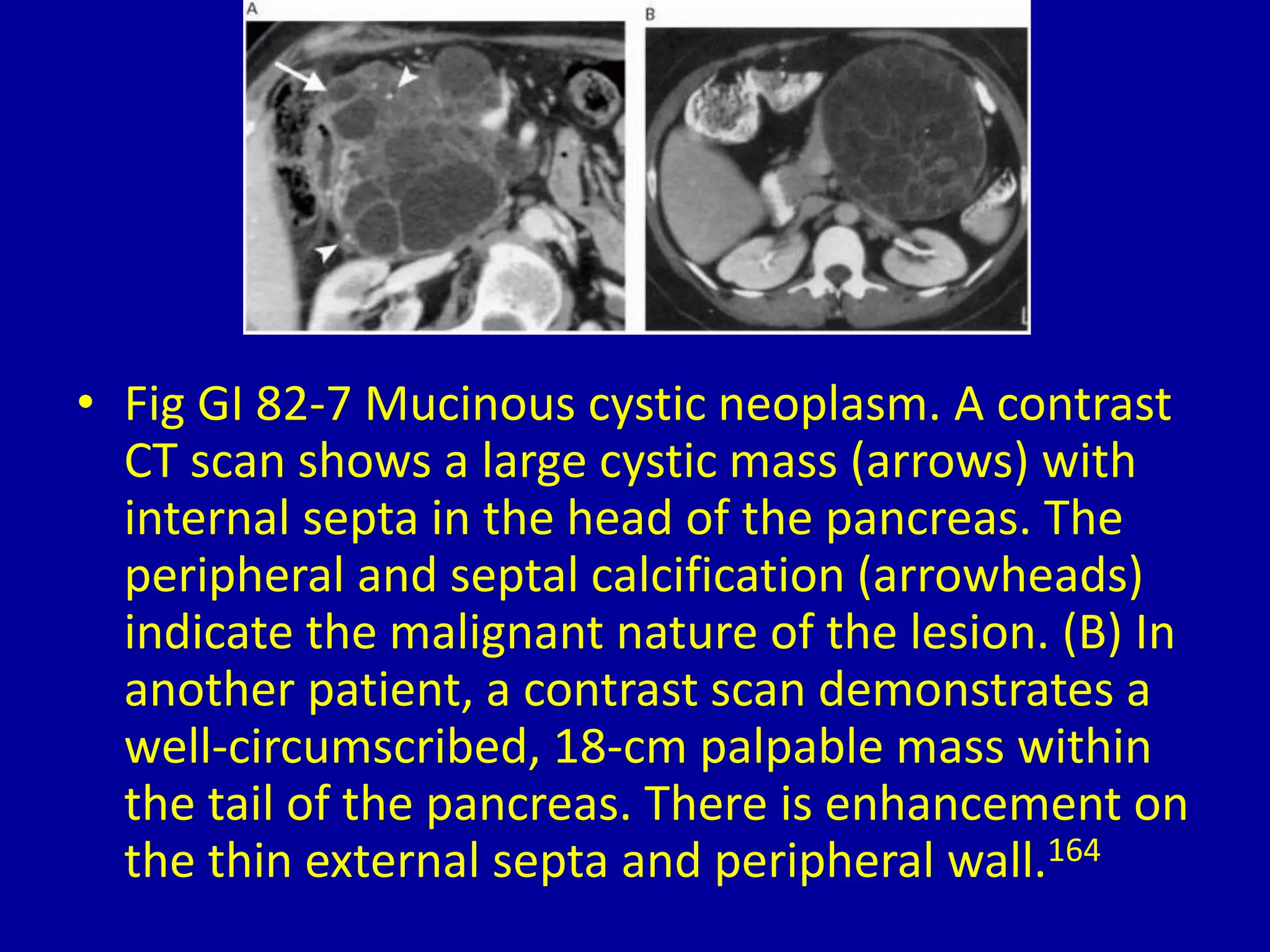 82 cystic pancreatic masses on ct and mri | PPTX