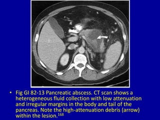 82 cystic pancreatic masses on ct and mri | PPTX