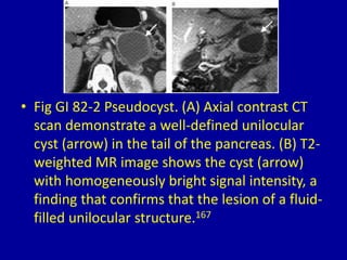 82 cystic pancreatic masses on ct and mri | PPTX