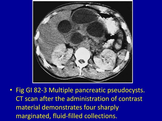82 cystic pancreatic masses on ct and mri | PPT