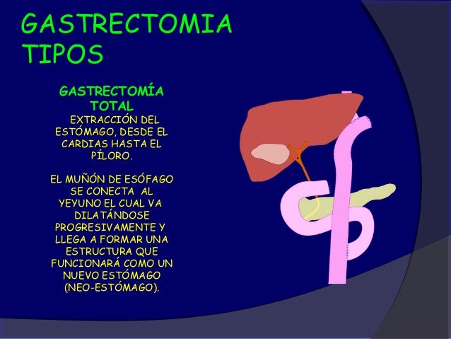 Cicatrizes De Gastrectomia Vertical