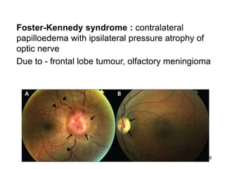 830_Optic_nerve_final copy 2.pptx | Brain and Nervous System Disorders ...
