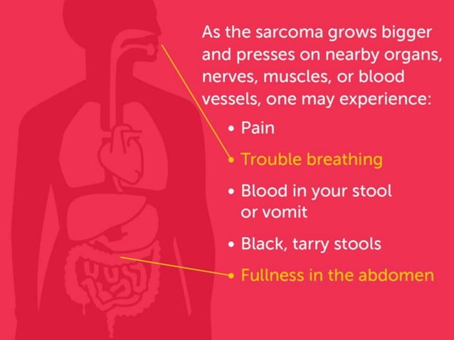 Soft Tissue Sarcomas: Symptoms and Risk Factors