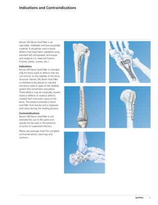 Norian SRS Rotary Mix | PDF
