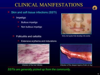 SCOURGE_OF_MRSA_97-2003 | PPT | Skin and Dermatology | Diseases and ...