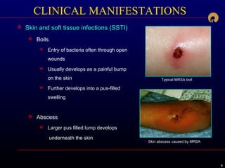 SCOURGE_OF_MRSA_97-2003 | PPT | Skin and Dermatology | Diseases and Conditions