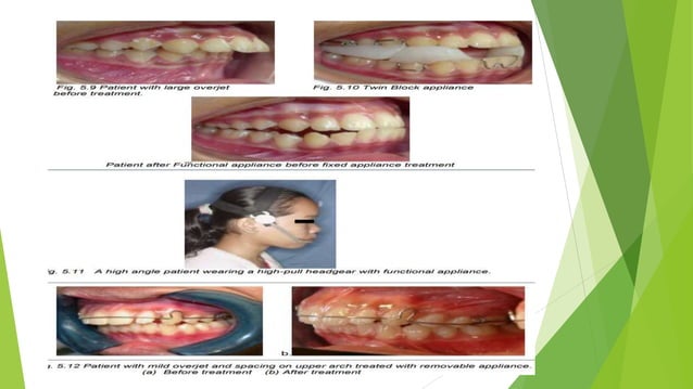 INTERCEPTIVE_ORTHODONTICS_BY_VIDHI.pptx