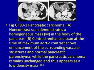 83 solid pancreatic masses on computed tomography | PPT