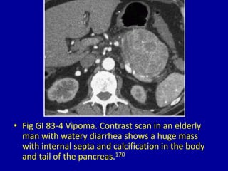 83 solid pancreatic masses on computed tomography | PPT