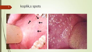 measles by ahmad | PPTX
