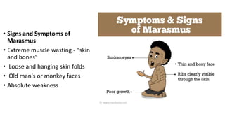 Protein Energy Malnutrition.pptx