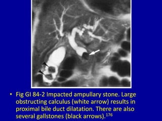 84 magnetic resonance cholangiography | PPT