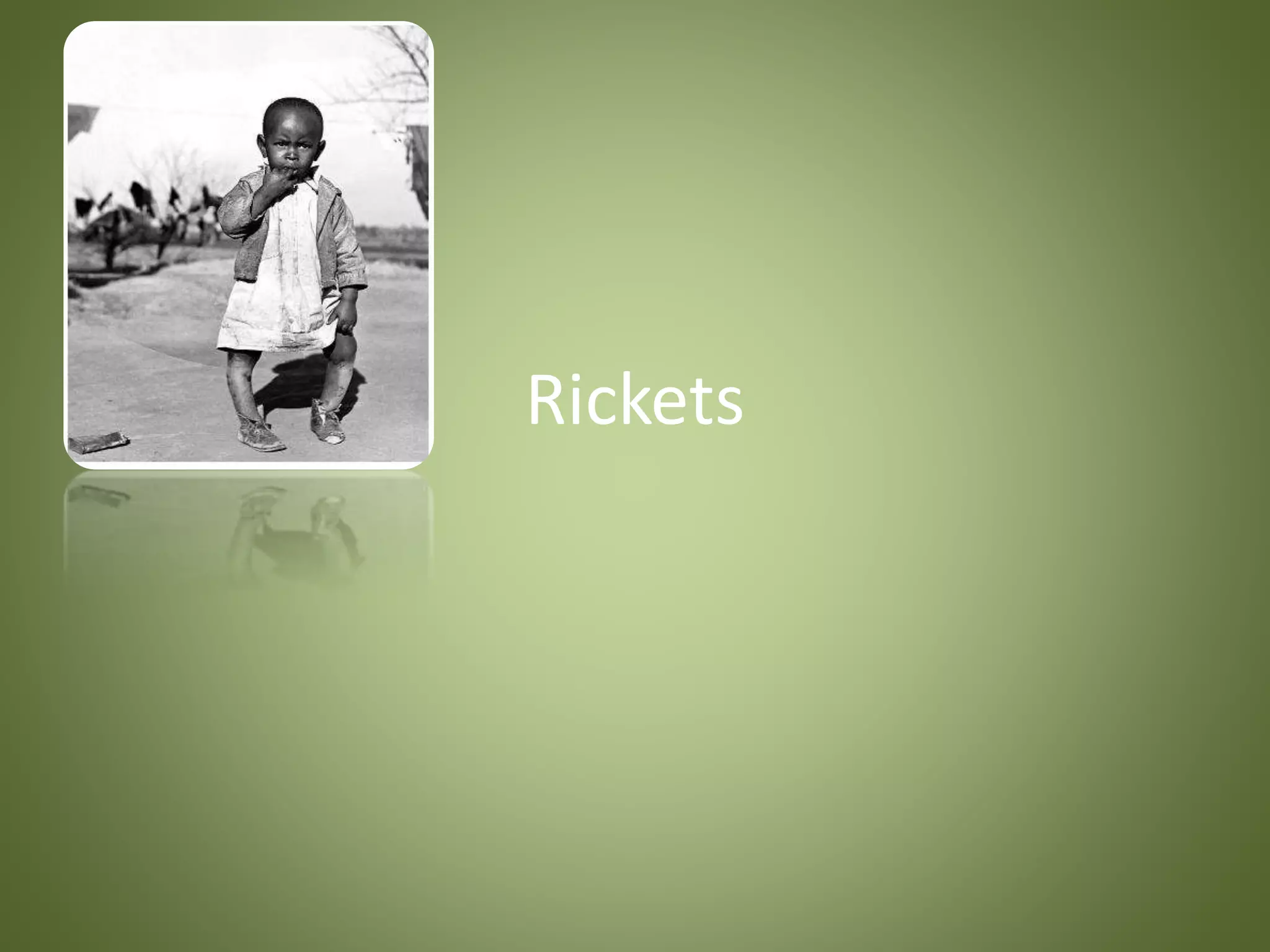 Rickets | PPTX
