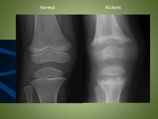 Rickets | PPTX