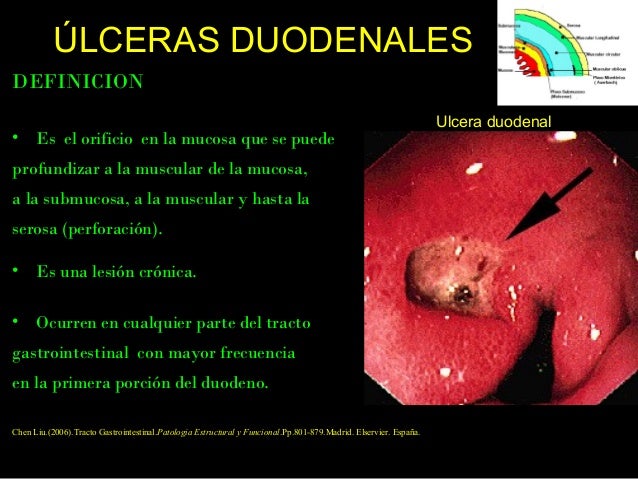 Gastritis, duodenitis y úlceras