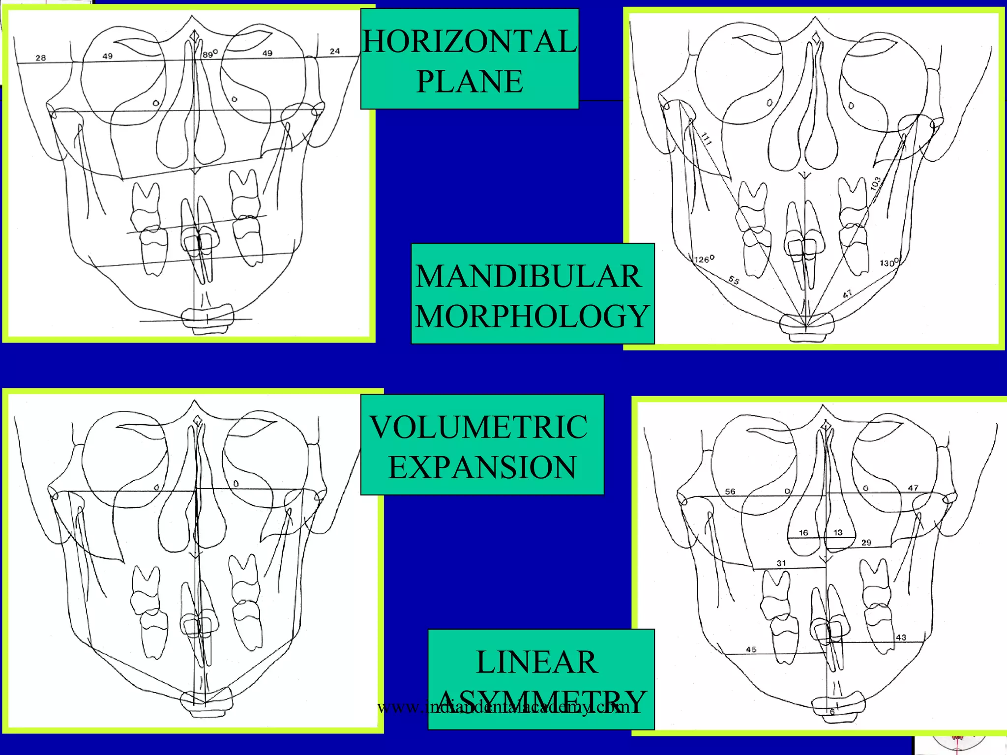 Management of deviated midline | PPT