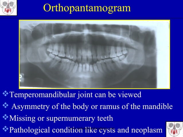 Management of deviated midline | PPT