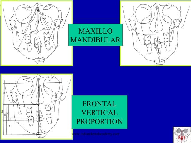 Management of deviated midline | PPT