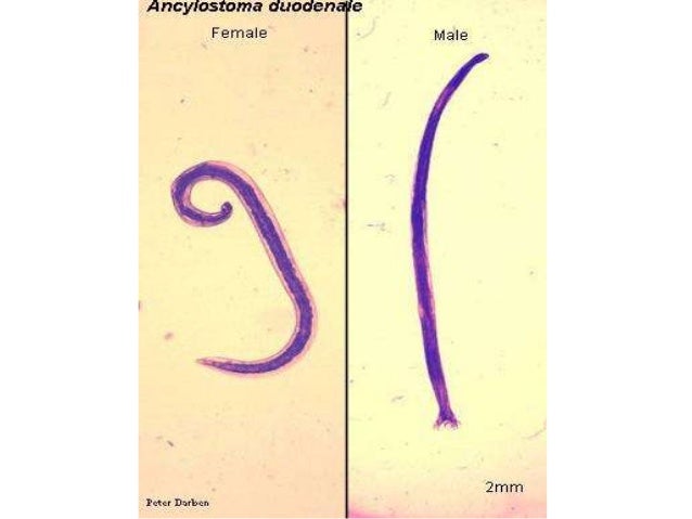 Hookworm Infestation