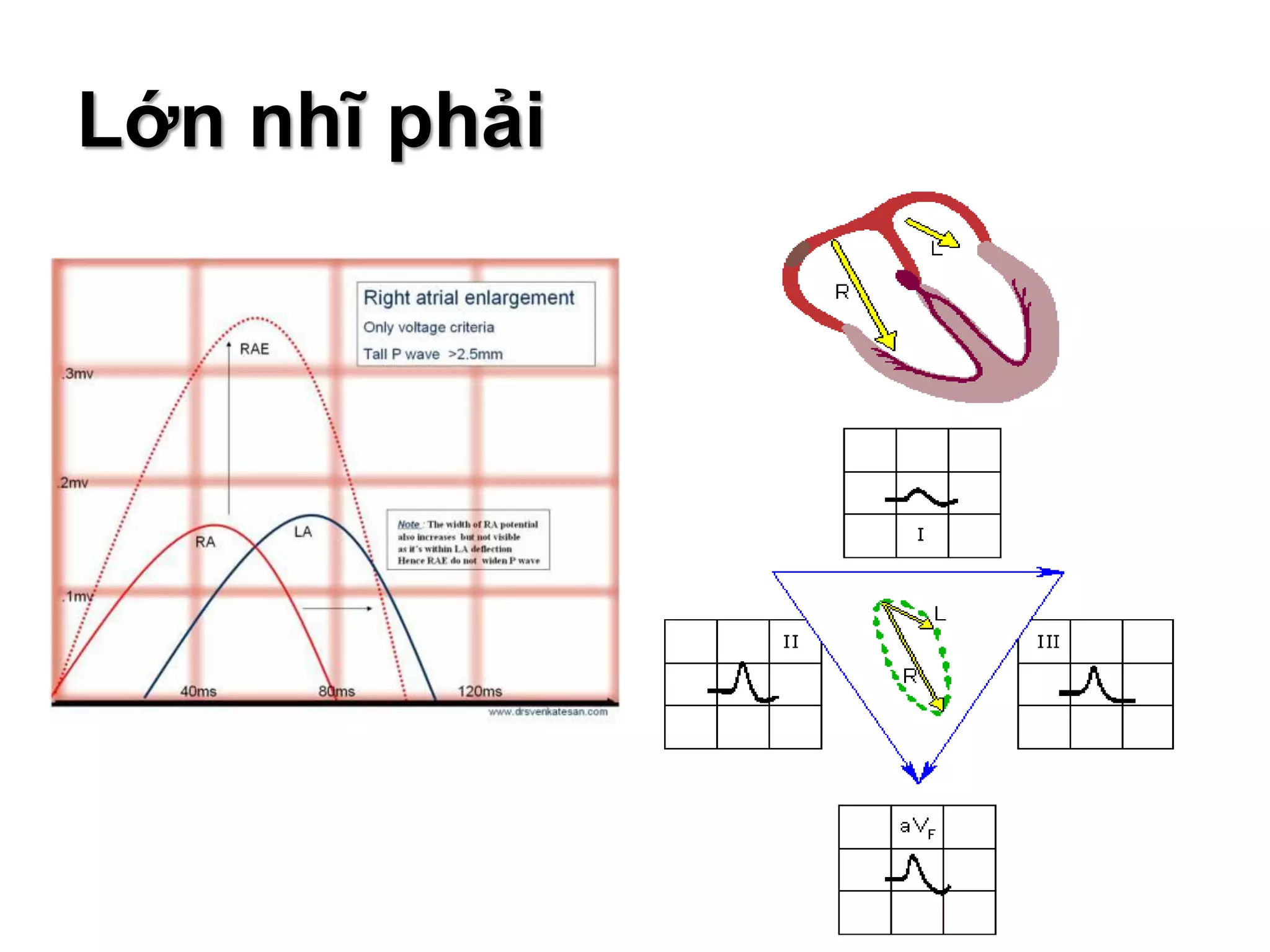 ECG TRONG LỚN NHĨ THẤT | PDF