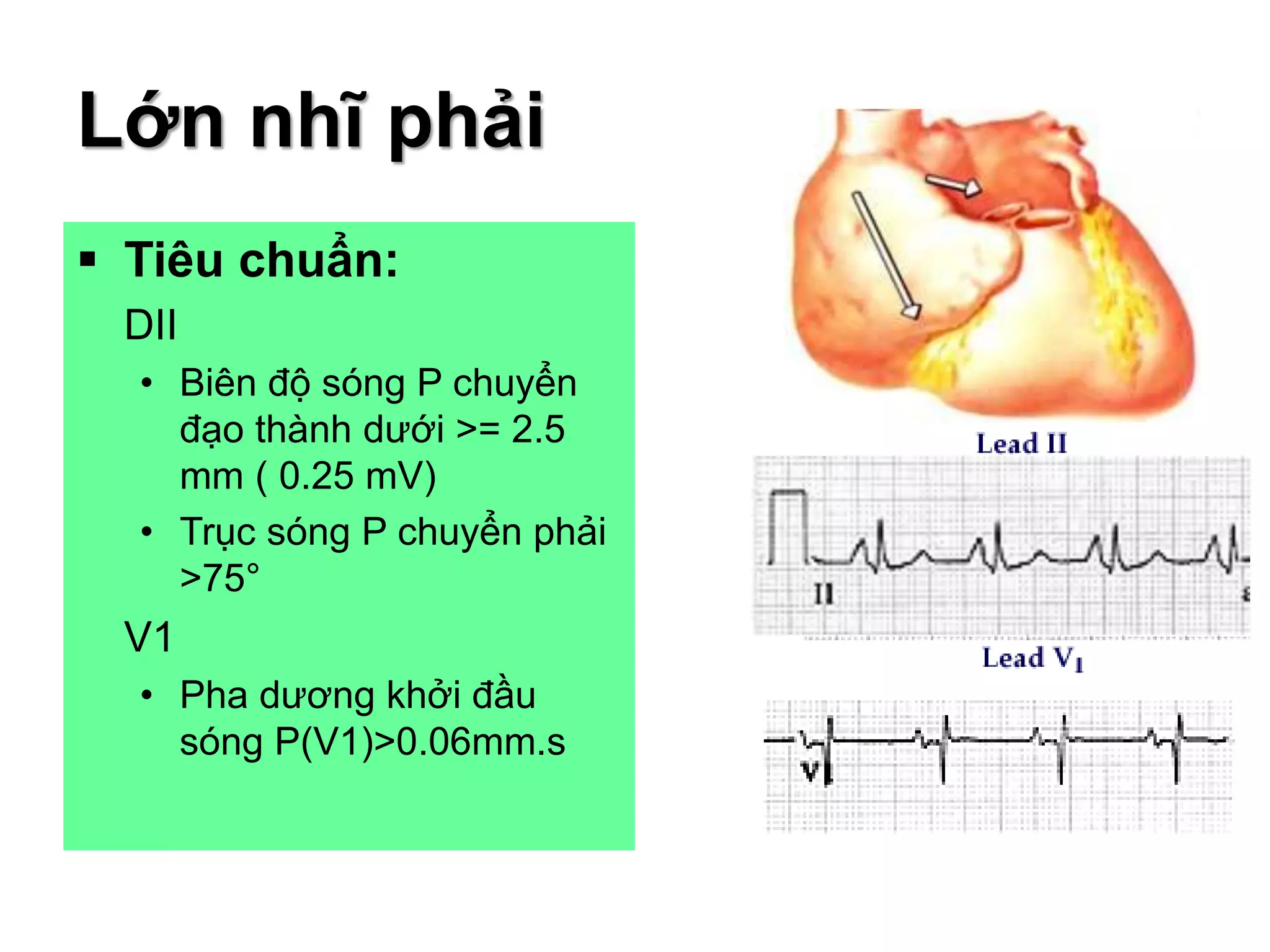 ECG TRONG LỚN NHĨ THẤT | PDF