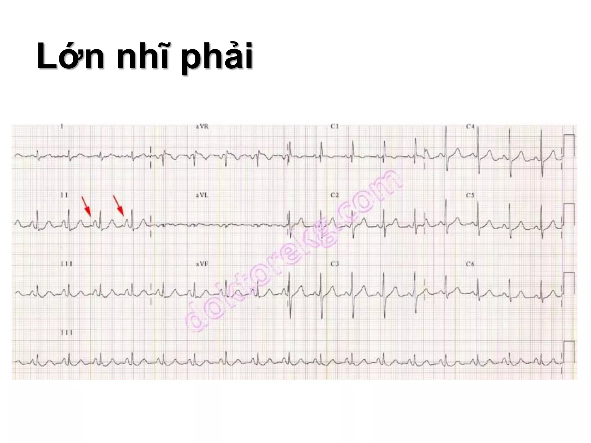 ECG TRONG LỚN NHĨ THẤT | PDF