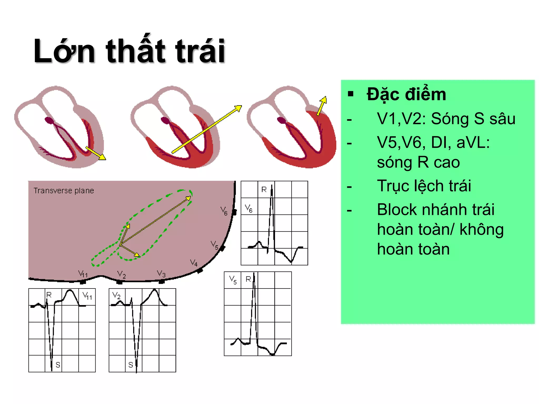 ECG TRONG LỚN NHĨ THẤT | PDF