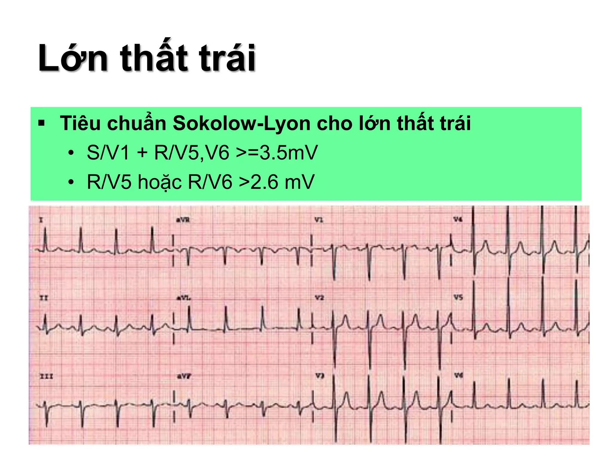 ECG TRONG LỚN NHĨ THẤT | PDF