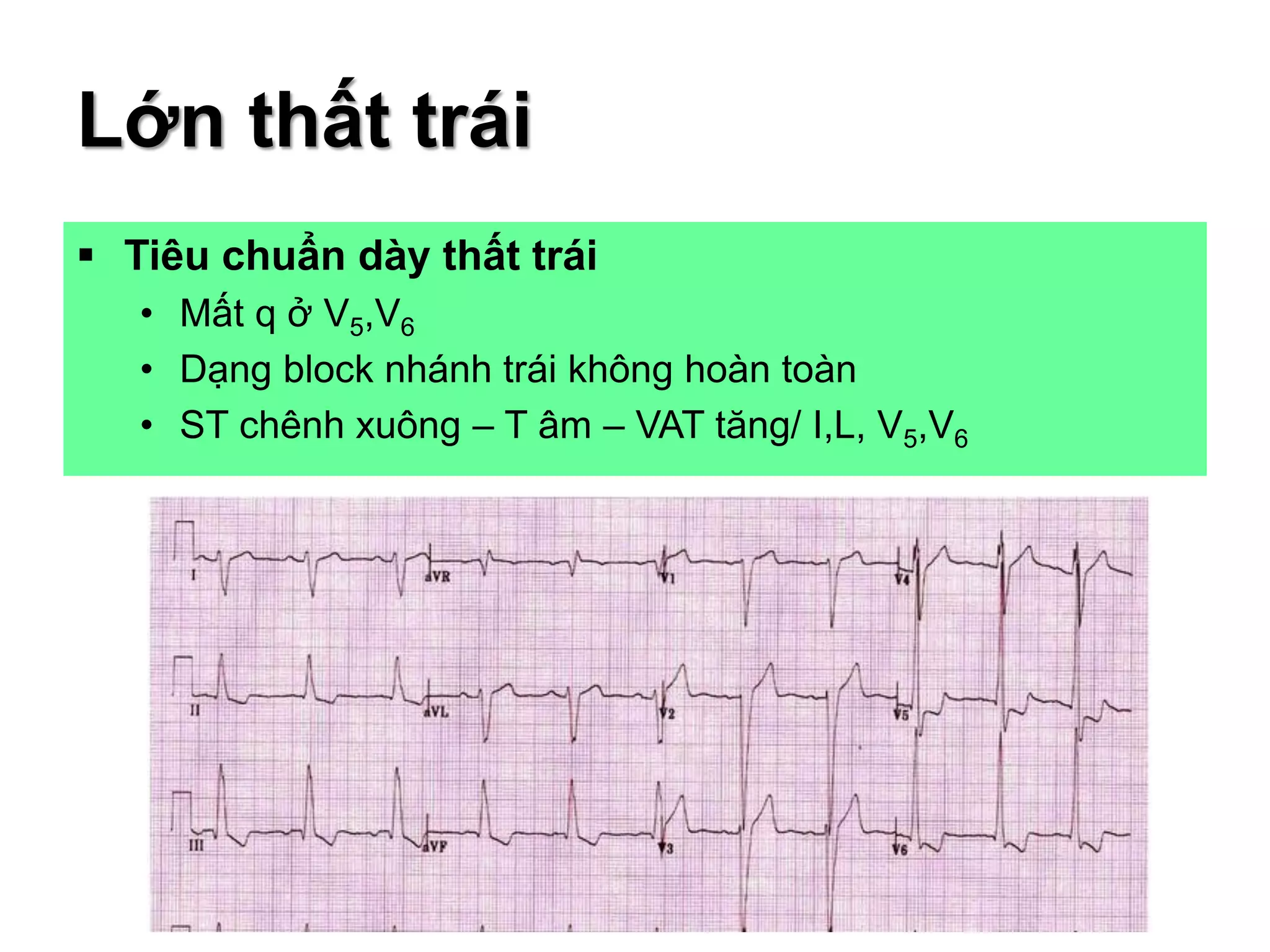 ECG TRONG LỚN NHĨ THẤT | PDF