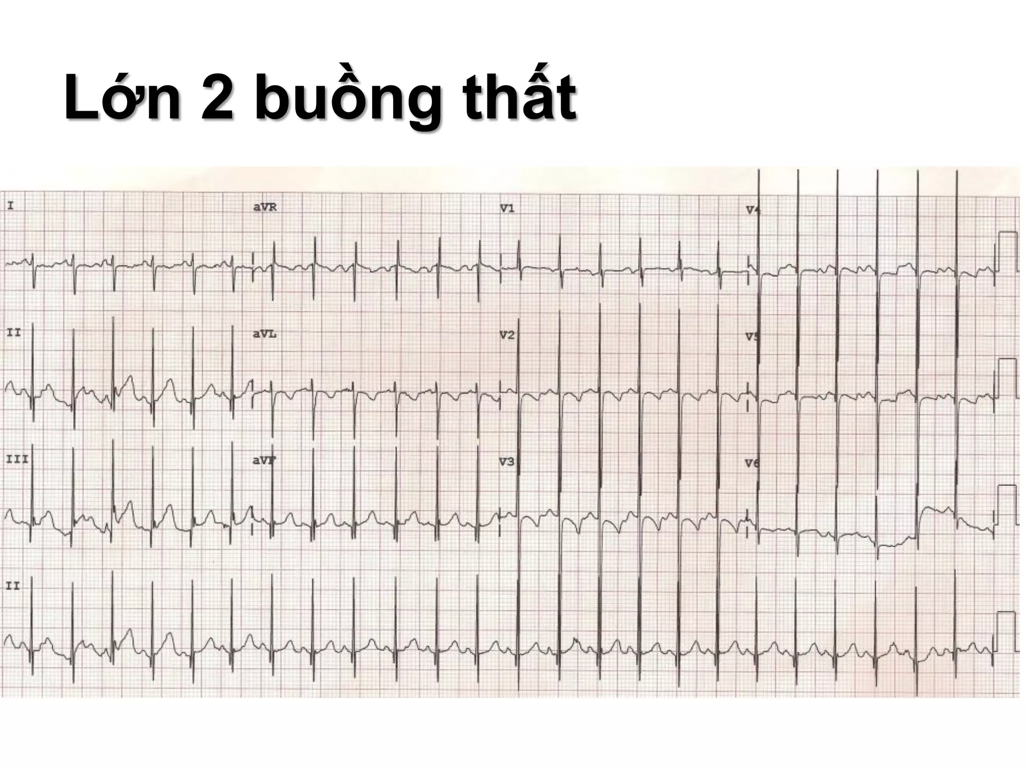 ECG TRONG LỚN NHĨ THẤT | PDF