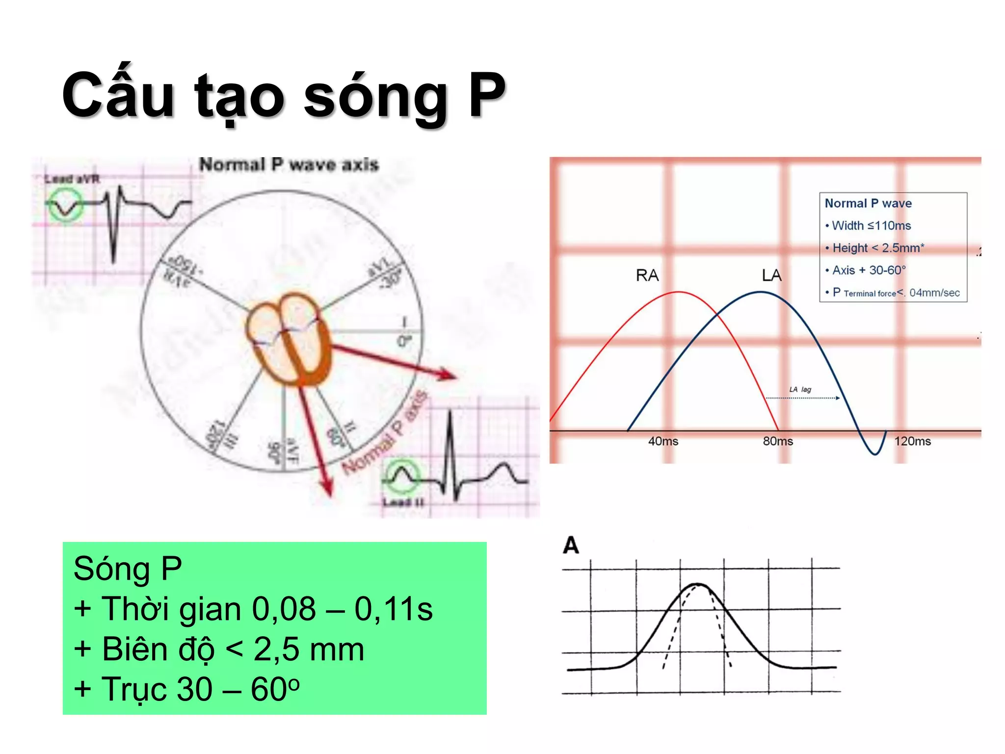 ECG TRONG LỚN NHĨ THẤT | PDF