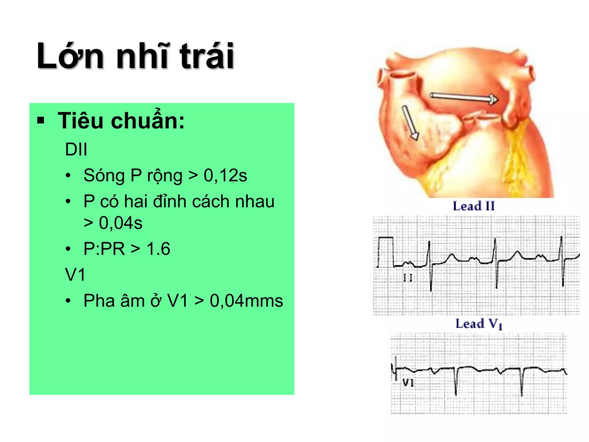 ECG TRONG LỚN NHĨ THẤT | PDF
