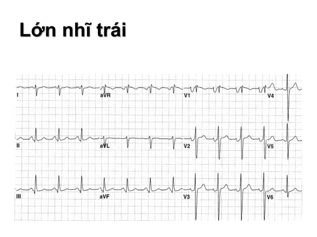 ECG TRONG LỚN NHĨ THẤT | PDF
