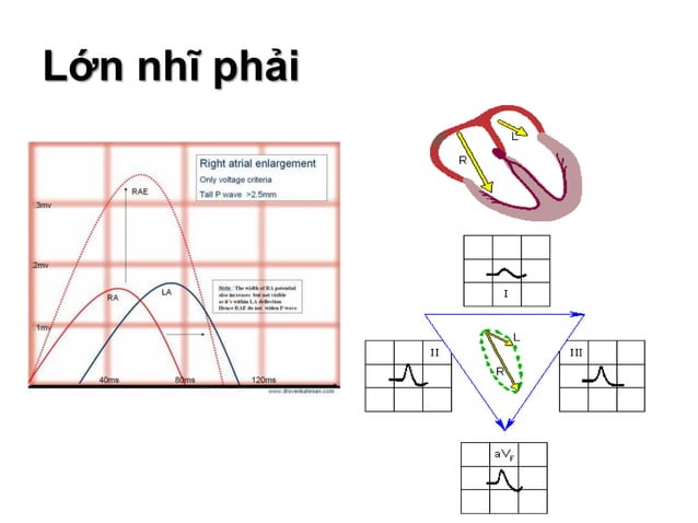 ECG TRONG LỚN NHĨ THẤT | PDF