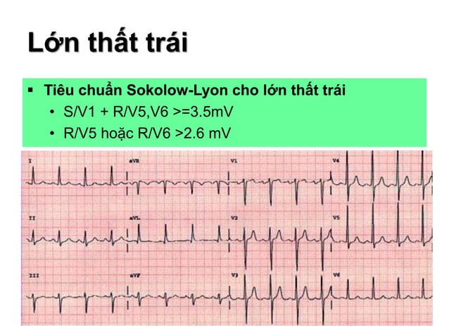 ECG TRONG LỚN NHĨ THẤT | PDF