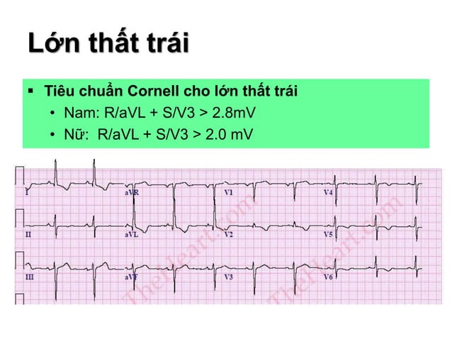 ECG TRONG LỚN NHĨ THẤT | PDF