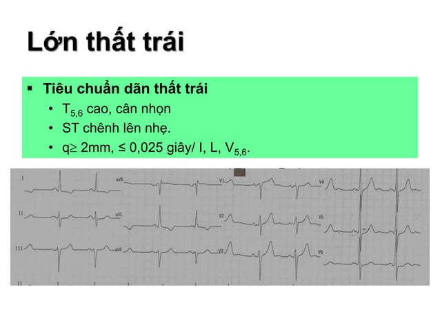 ECG TRONG LỚN NHĨ THẤT | PDF