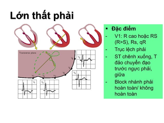 ECG TRONG LỚN NHĨ THẤT | PDF