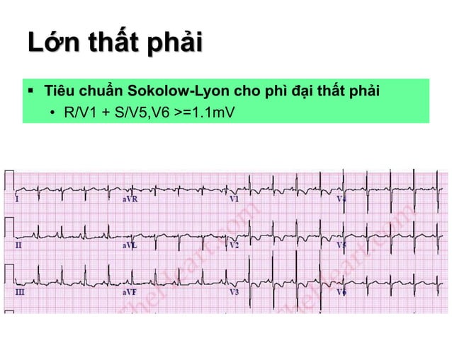 ECG TRONG LỚN NHĨ THẤT | PDF