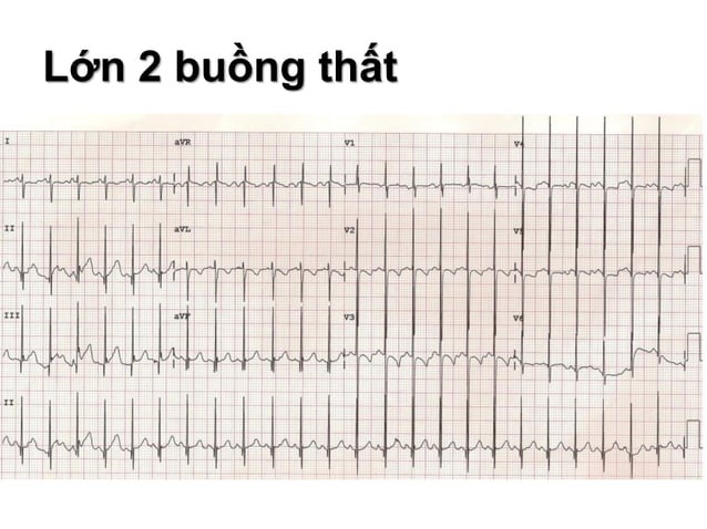 ECG TRONG LỚN NHĨ THẤT | PDF