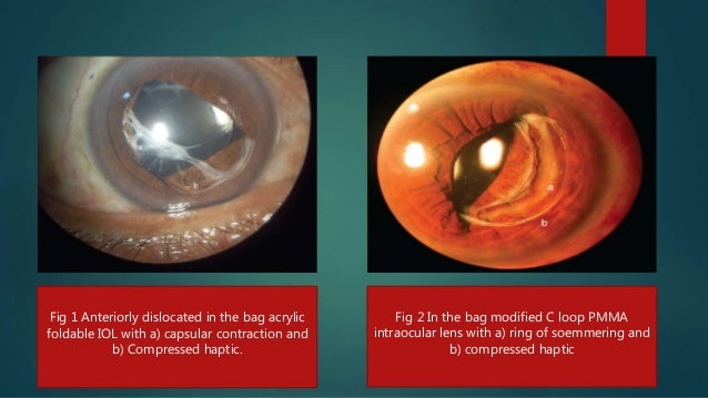 Bilateral Spontaneous Anterior Dislocation Of Intraocular Lens With T…