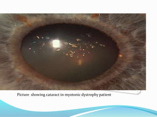 MYOTONIC DYSTROPHY | PPTX