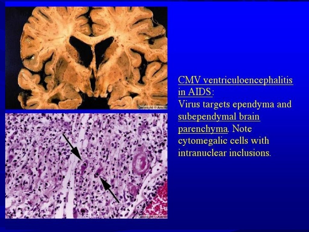 8679901 central-nervous-system-pathology