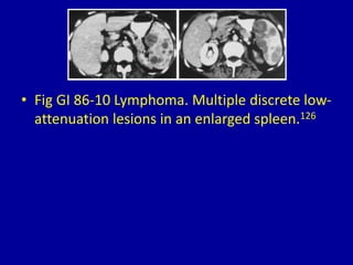 86 decreased attenuation masses in the spleen | PPTX