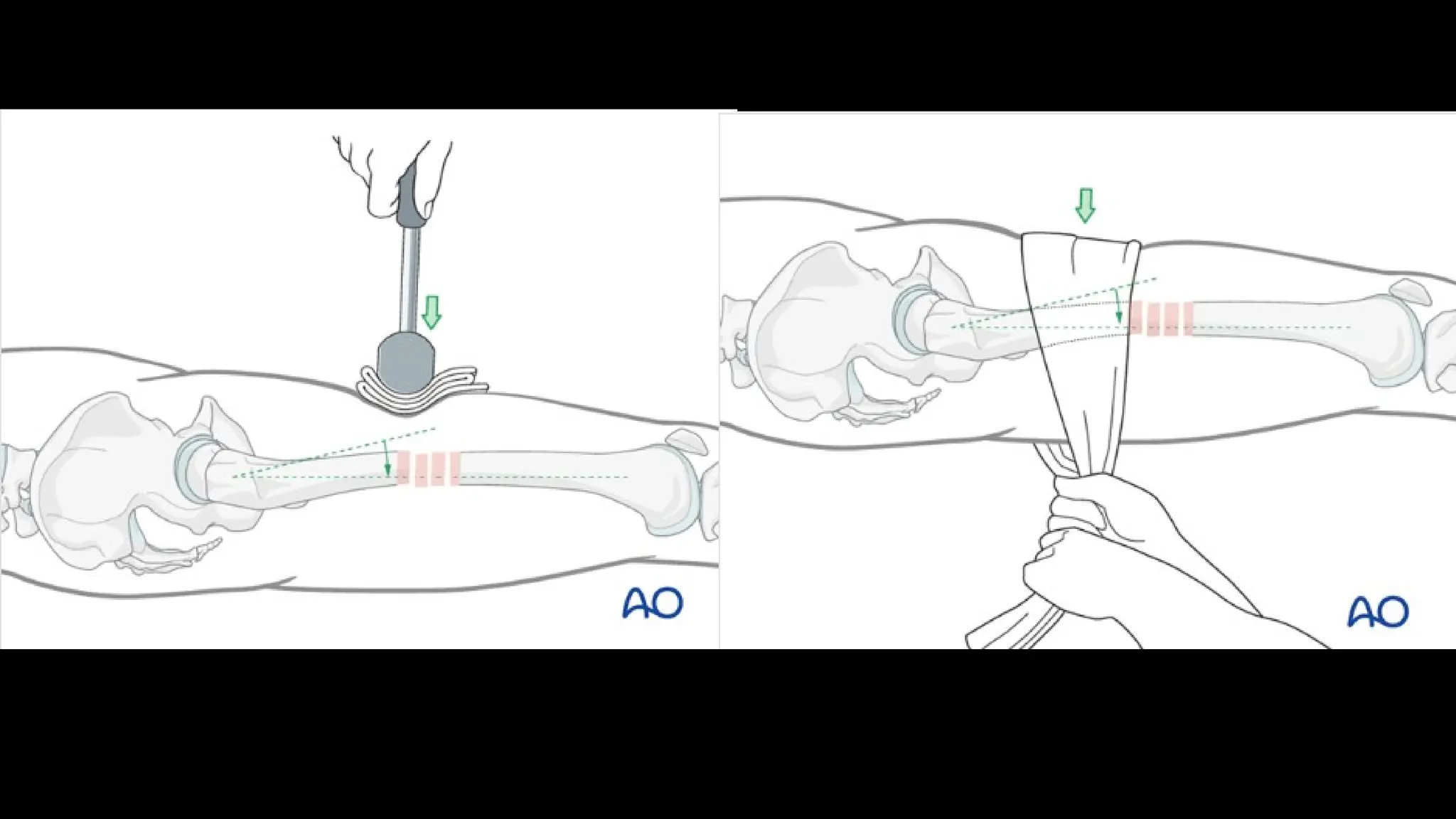 Pre operative conference diaphyseal Femur.pptx